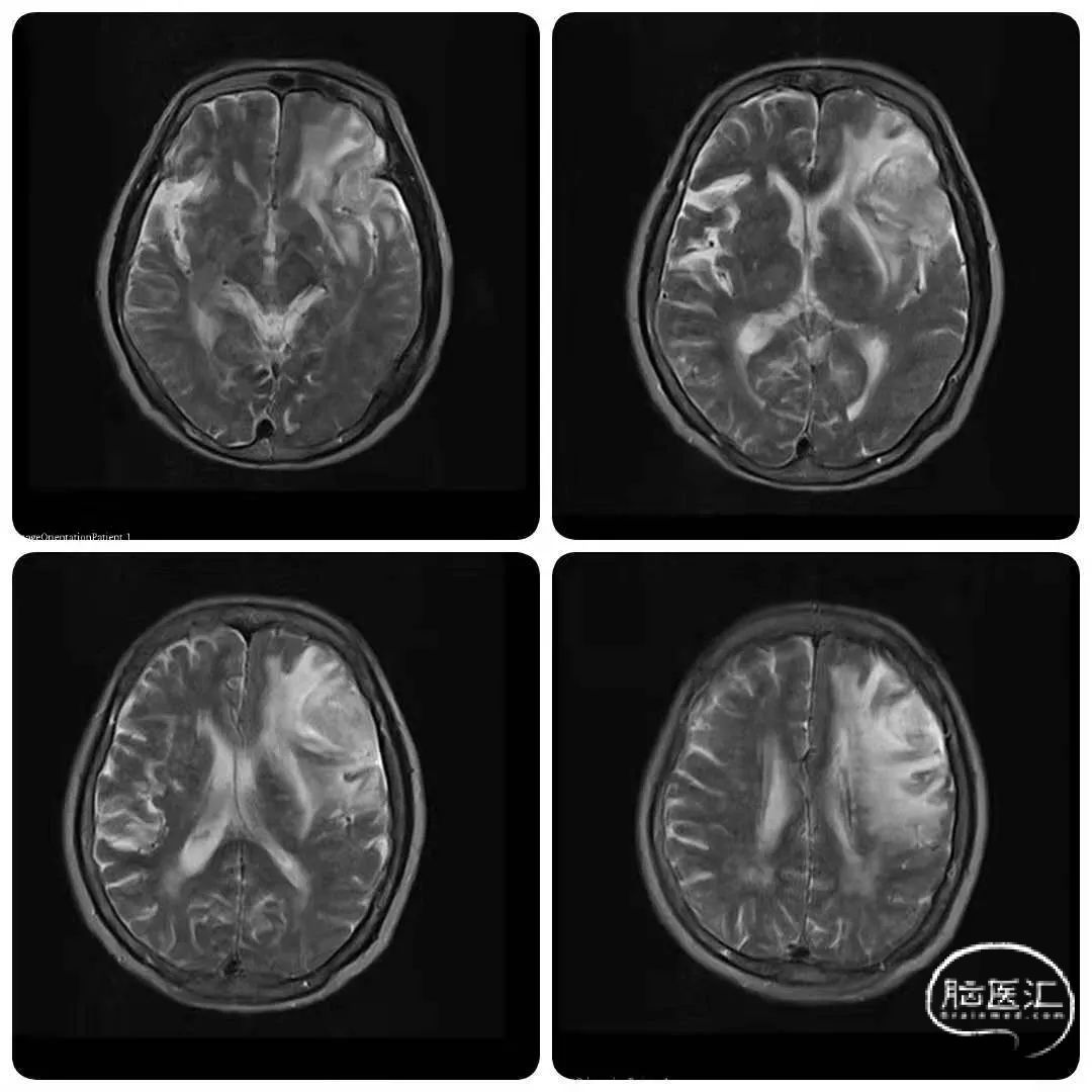 多模态影像融合下80岁老太颅内肿瘤切除术 - 脑医汇